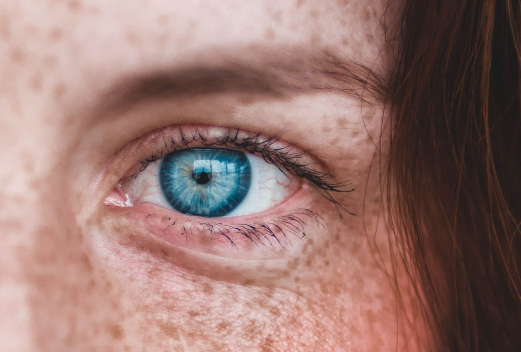 What is pigmentary glaucoma and how does it occur? | Optimax